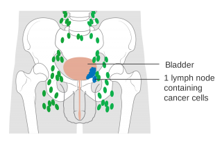 Bladder Cancer l Diagnosis, Symptoms, Treatments and Prognosis